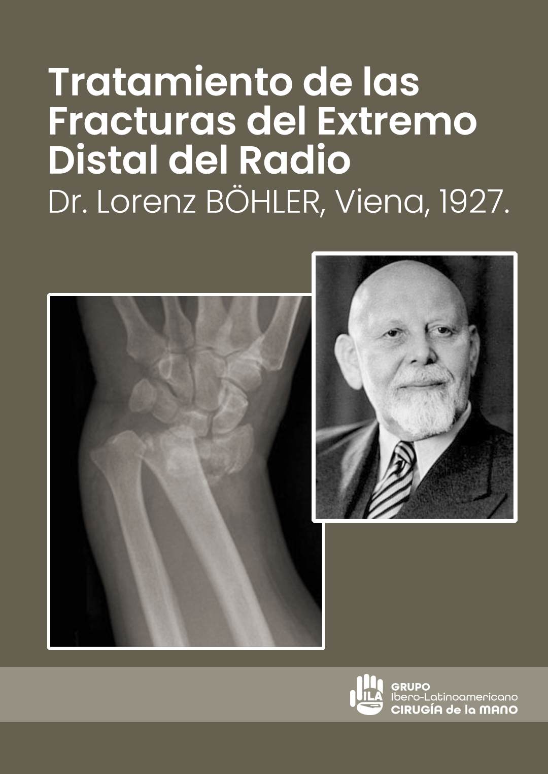 Tratamiento de las Fracturas del Extremo Distal del Radio | Dr. Lorenz ...